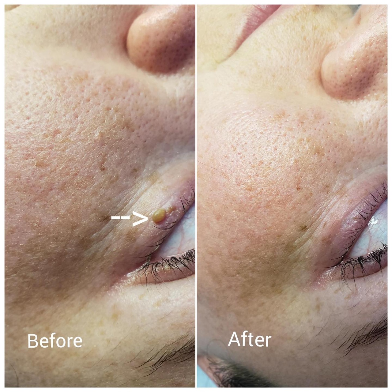 Skin irregularities - noninvasive method | Violet Skin Boutique
